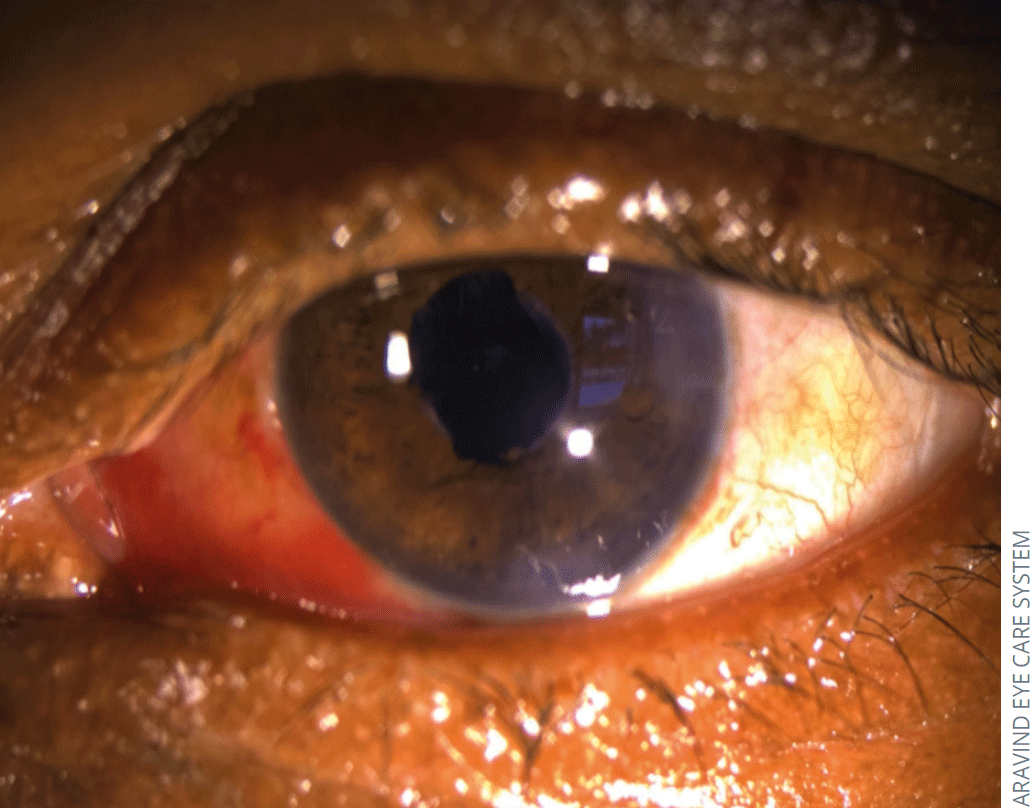 Managing cataract surgery in patients with uveitis | Community Eye ...