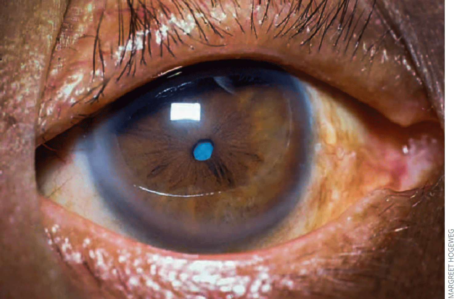 Managing cataract surgery in patients with small pupils | Community Eye ...