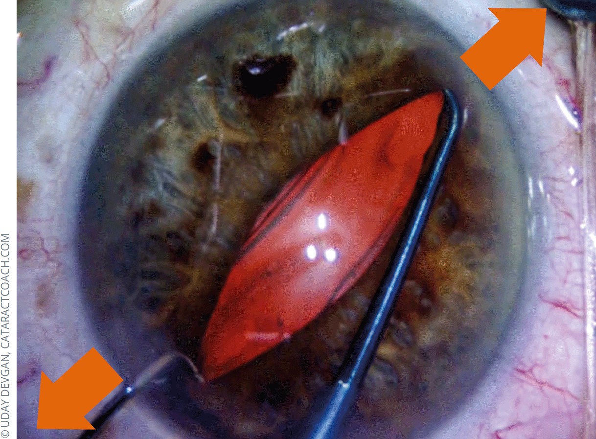 Managing cataract surgery in patients with small pupils | Community Eye ...