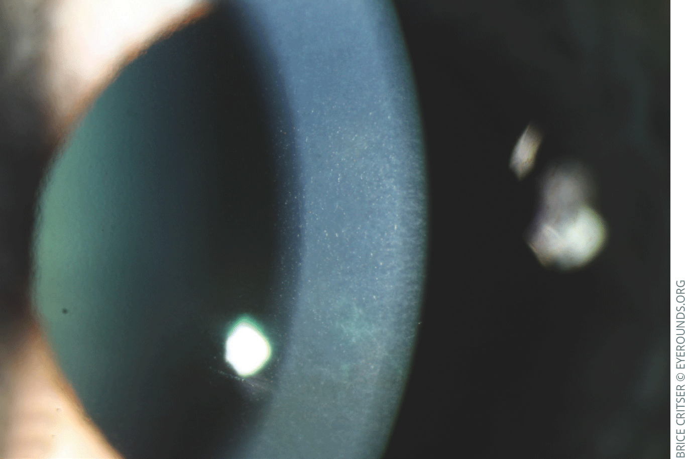 Cataract surgery in patients with Fuchs’ endothelial corneal dystrophy ...