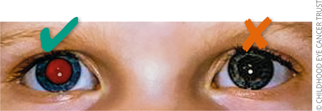 Testing the red reflex | Community Eye Health Journal