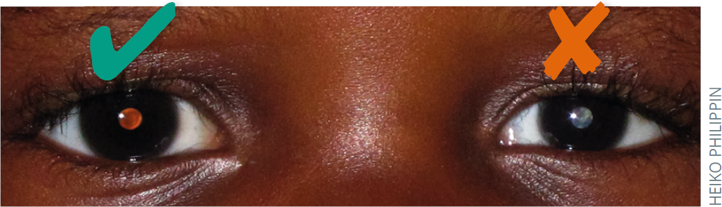 Testing the red reflex | Community Eye Health Journal