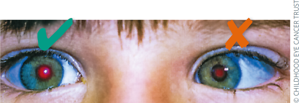 Testing the red reflex | Community Eye Health Journal