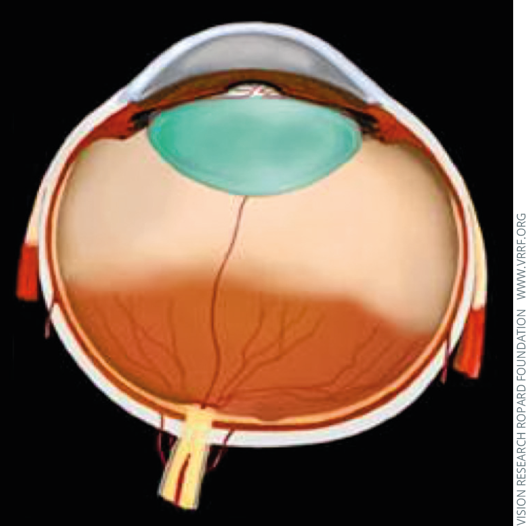 How does ROP develop? | Community Eye Health Journal