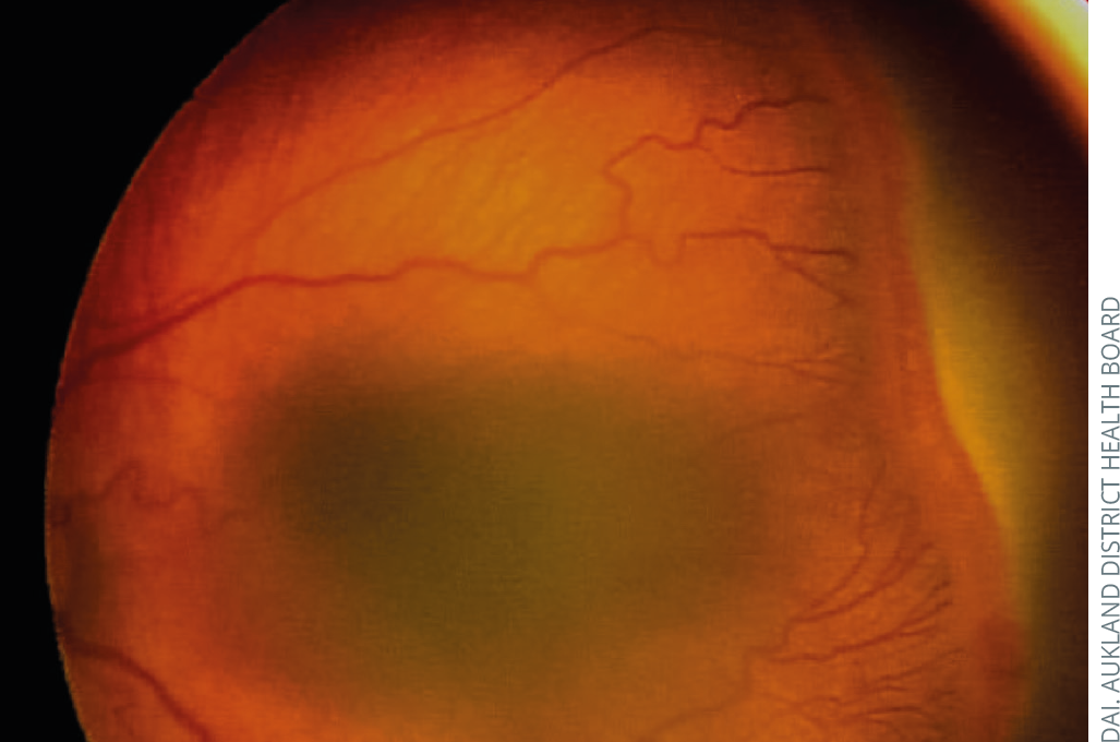 Classifying retinopathy of prematurity | Community Eye Health Journal