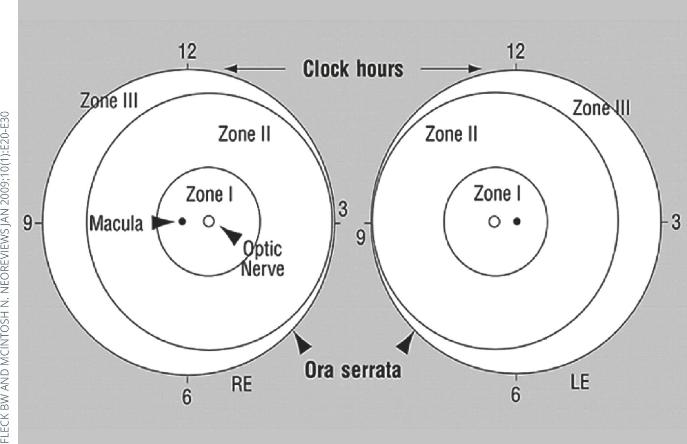 Classifying retinopathy of prematurity | Community Eye Health Journal