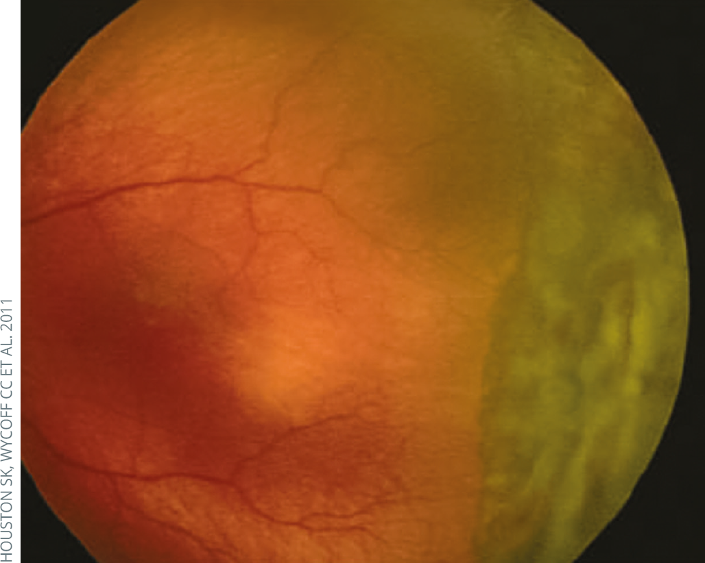 Treating ROP: how and when | Community Eye Health Journal