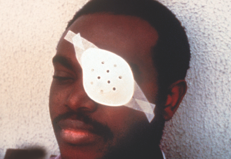 How to apply an eye pad, shield, and bandage | Community Eye Health Journal