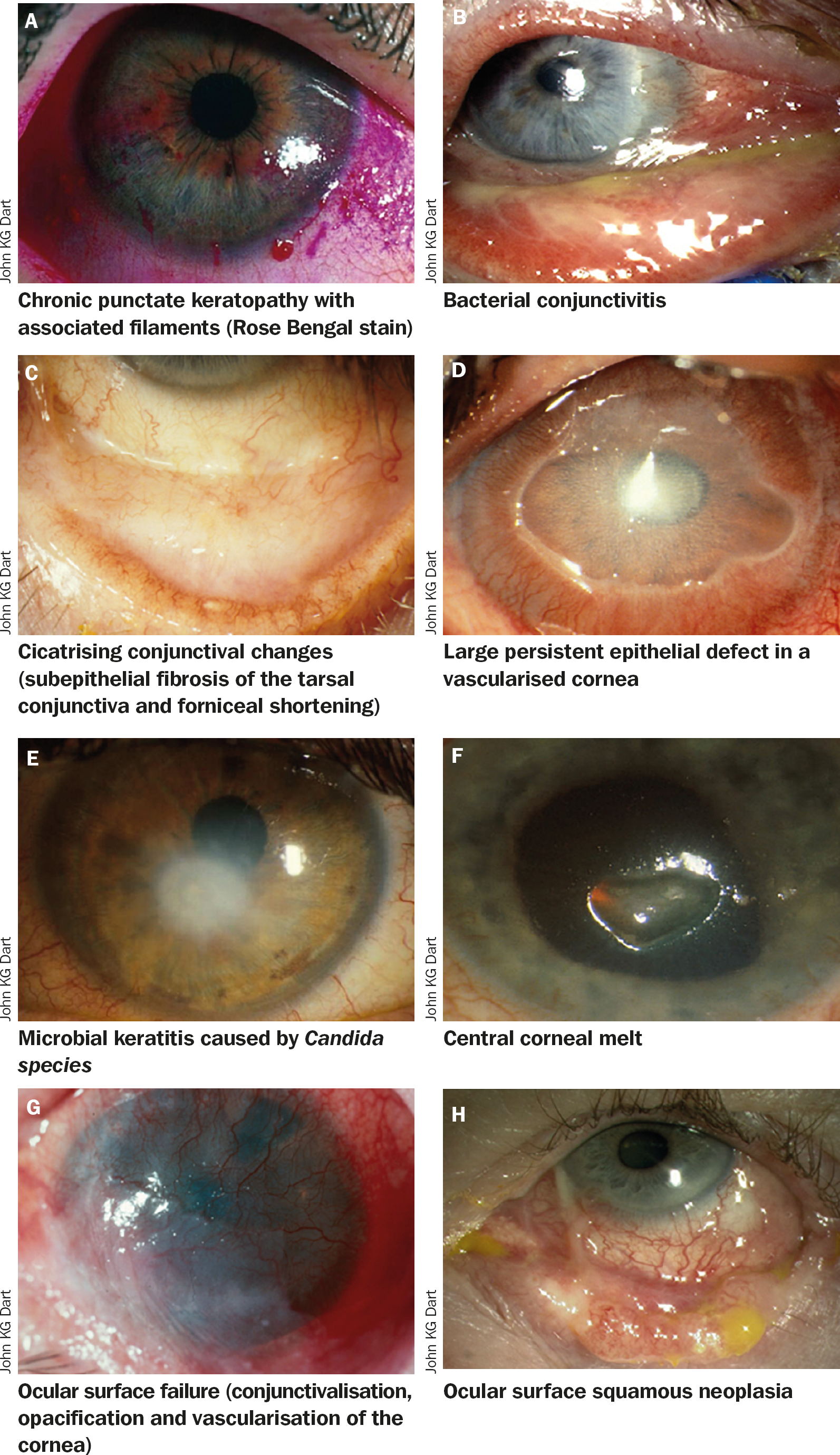 Managing ocular surface disease: a common-sense approach | Community ...