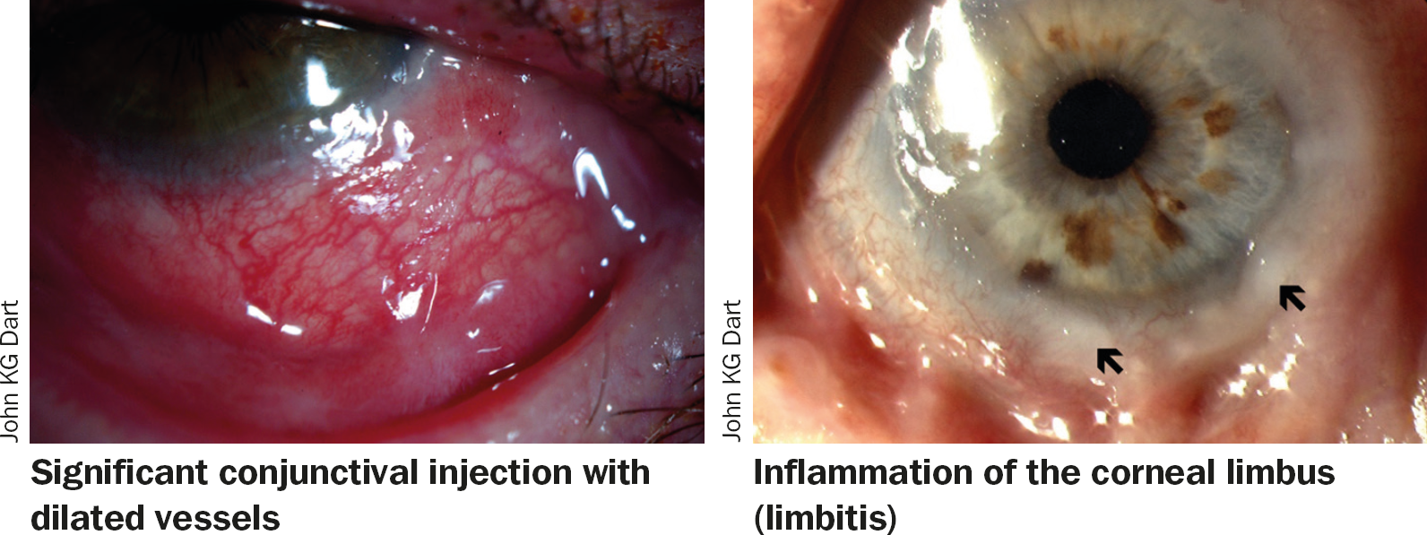 Managing ocular surface disease: a common-sense approach | Community ...