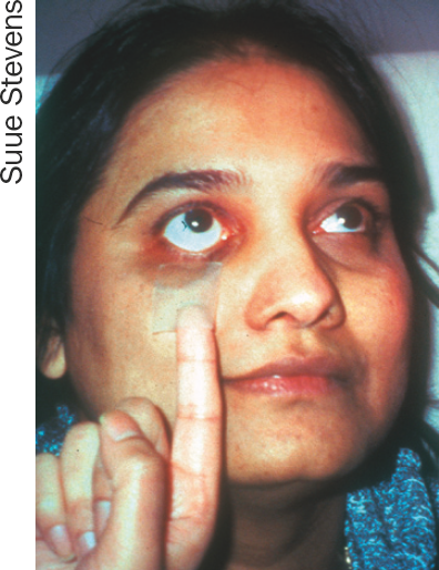 Tape correction for lower eyelid entropion | Community Eye Health Journal
