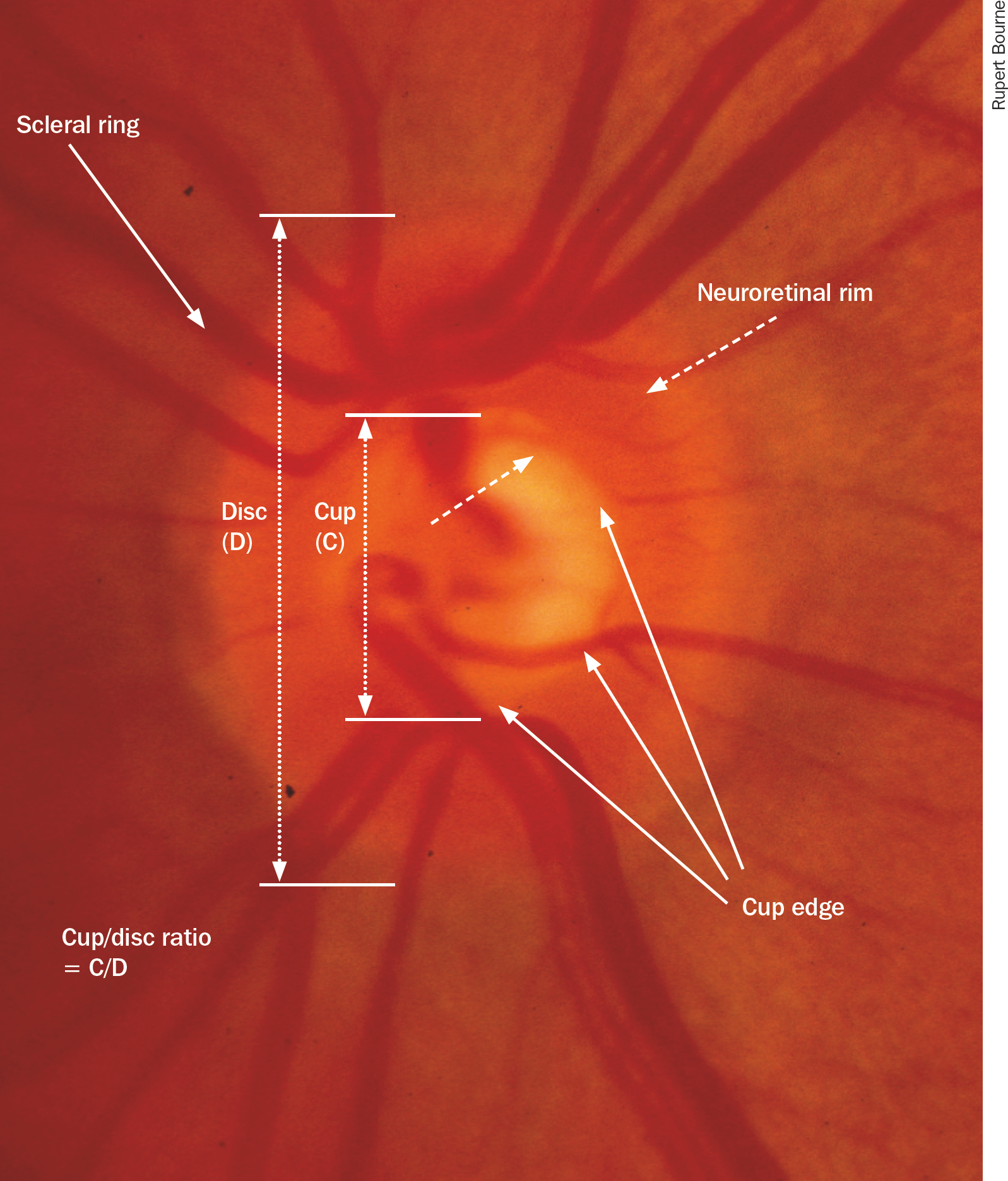 The optic nerve head in glaucoma | Community Eye Health Journal