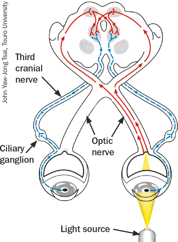 How to test for a relative afferent pupillary defect (RAPD) | Community ...