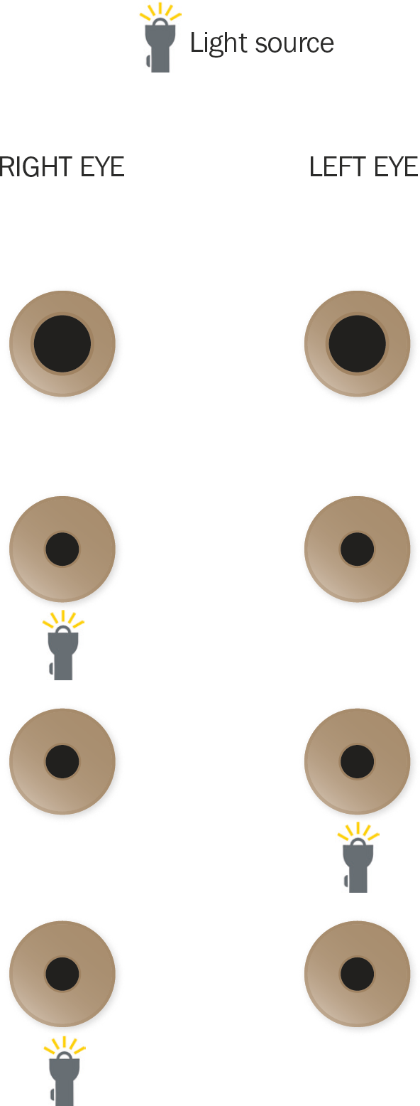 How to test for a relative afferent pupillary defect (RAPD) | Community ...