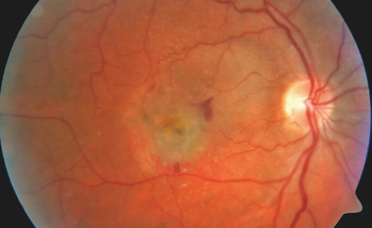 Diseases at the back of the eye | Community Eye Health Journal