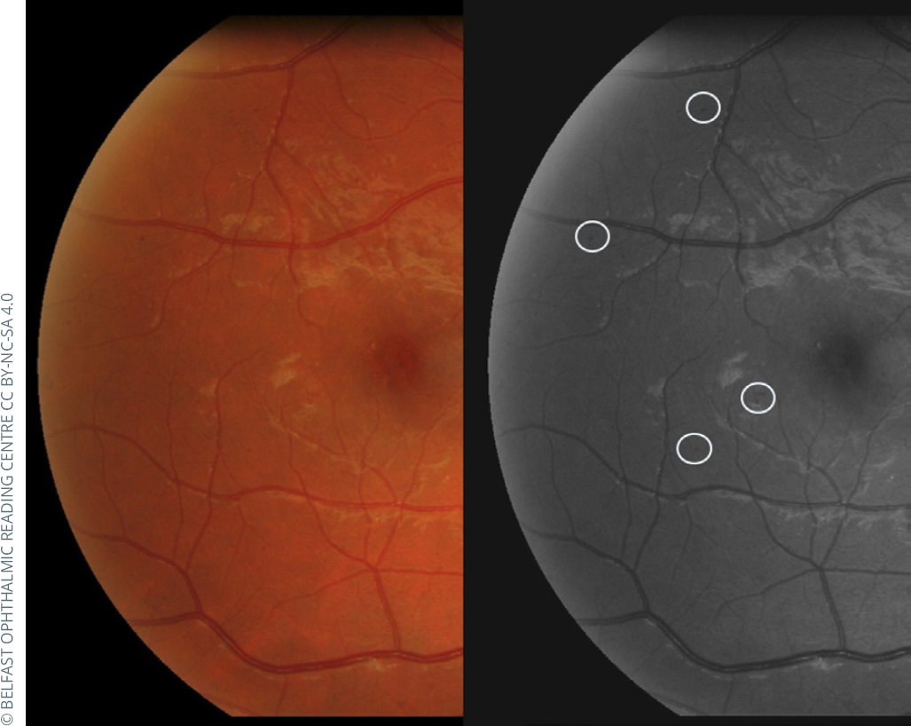Grading images for diabetic retinopathy: tips and guidelines ...