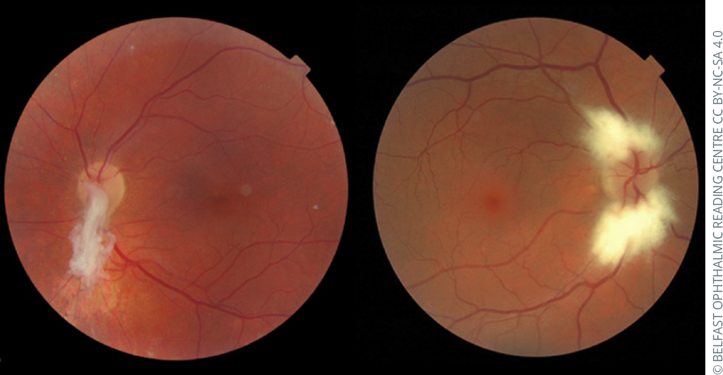 Grading images for diabetic retinopathy: tips and guidelines ...