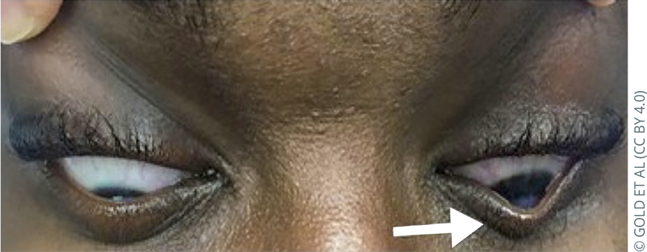 Keratoconus: an introduction | Community Eye Health Journal