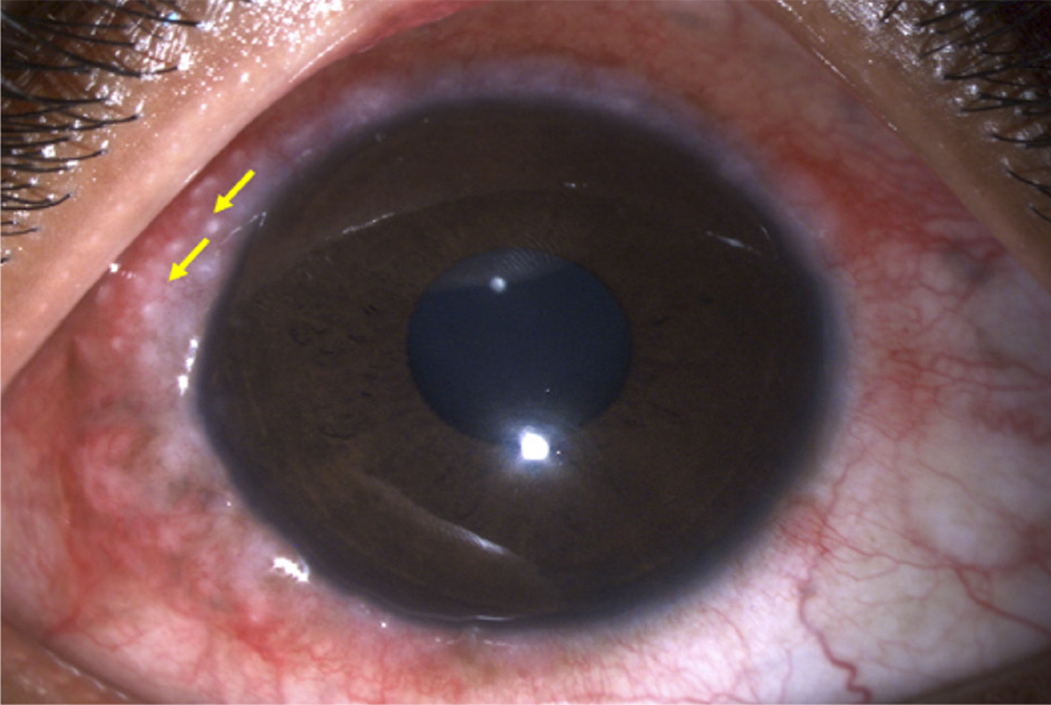Managing ocular allergy | Community Eye Health Journal