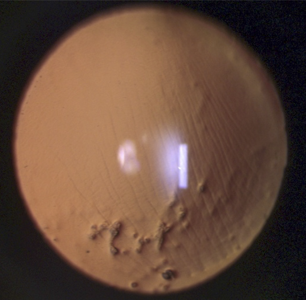 Complications in patients who have undergone laser refractive surgery ...