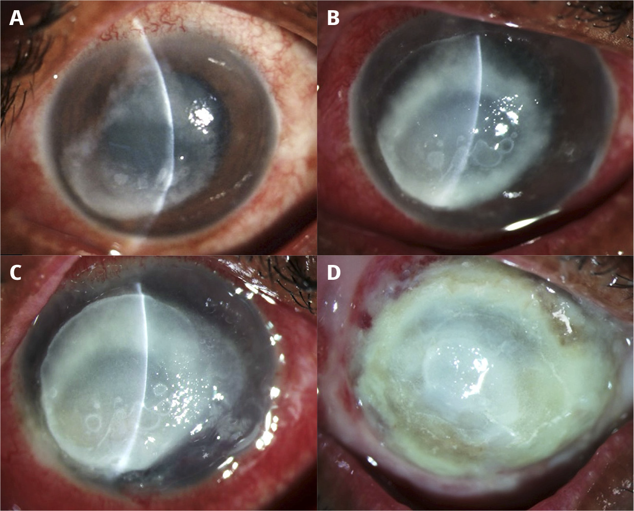 Pythium insidiosum: the organism that mimics fungal keratitis ...