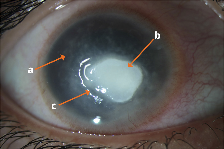 Pythium insidiosum: the organism that mimics fungal keratitis ...