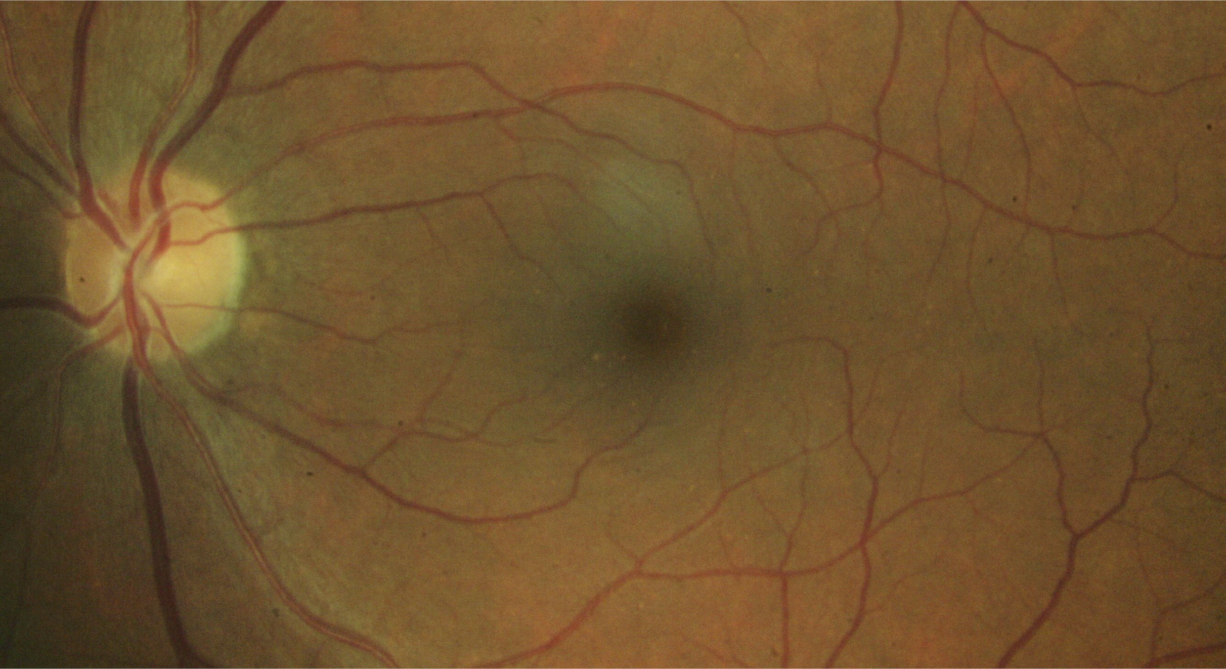 Maculopathies made simple | Community Eye Health Journal