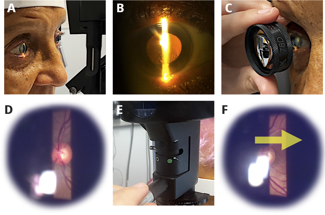 Clinical examination of the macula | Community Eye Health Journal