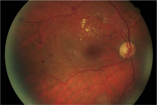 Diabetic macular oedema (DMO): an introduction | Community Eye Health ...