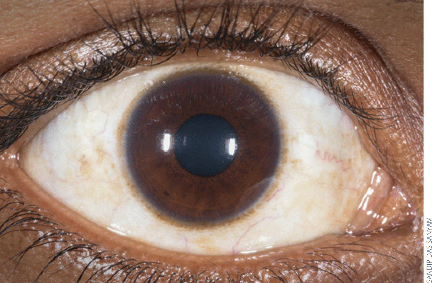 How to examine the front of the eye | Community Eye Health Journal