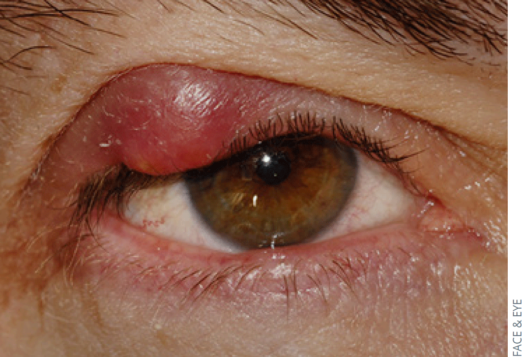 How to examine the front of the eye | Community Eye Health Journal