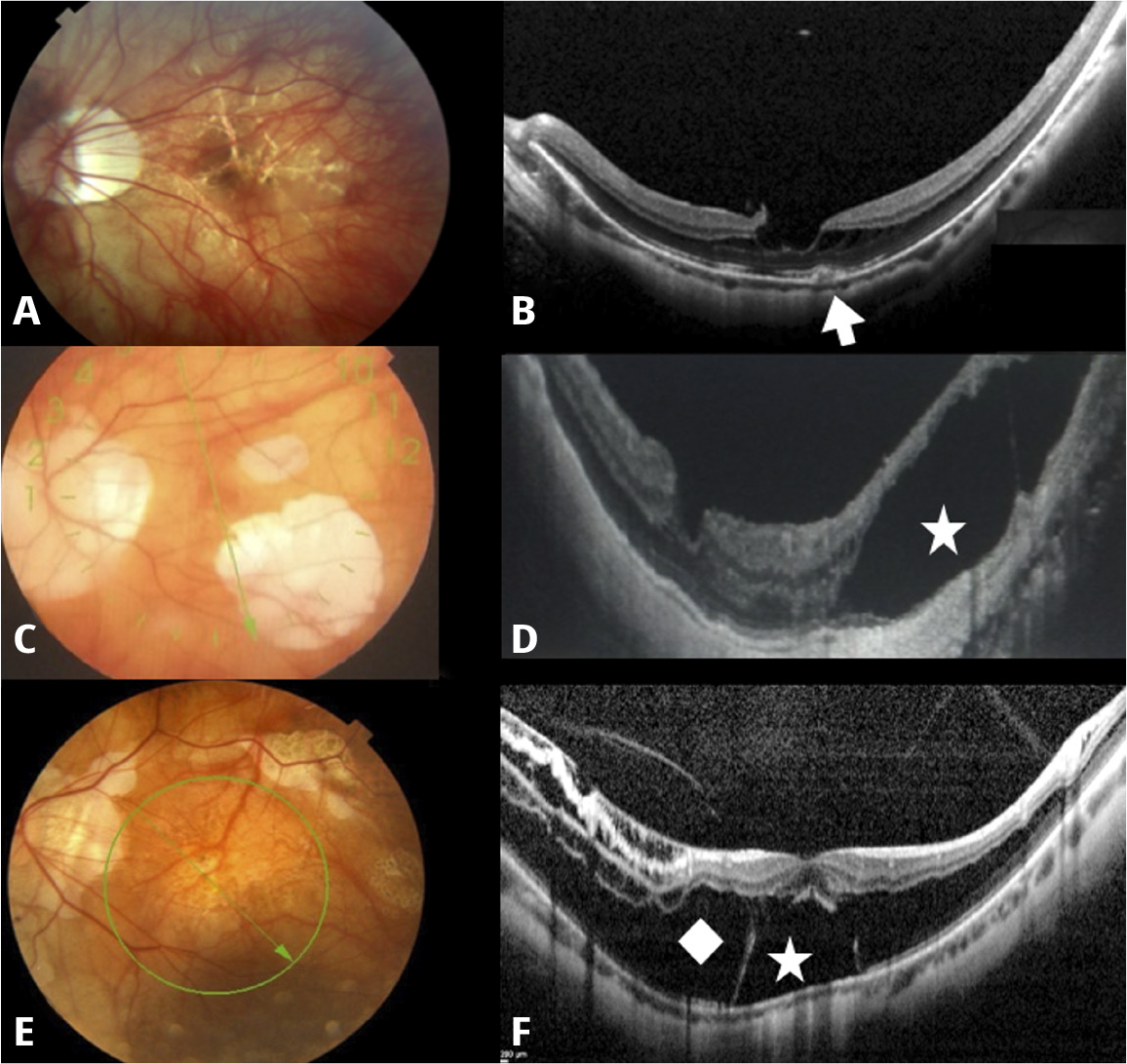 Management of myopic traction maculopathy | Community Eye Health Journal