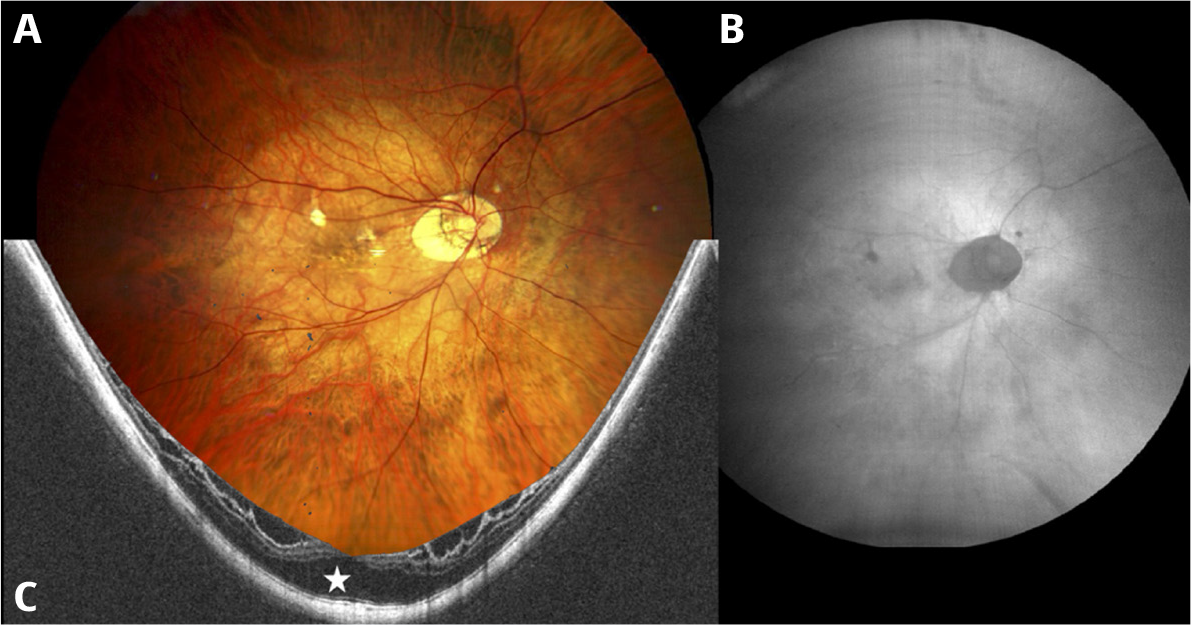 Management of myopic traction maculopathy | Community Eye Health Journal
