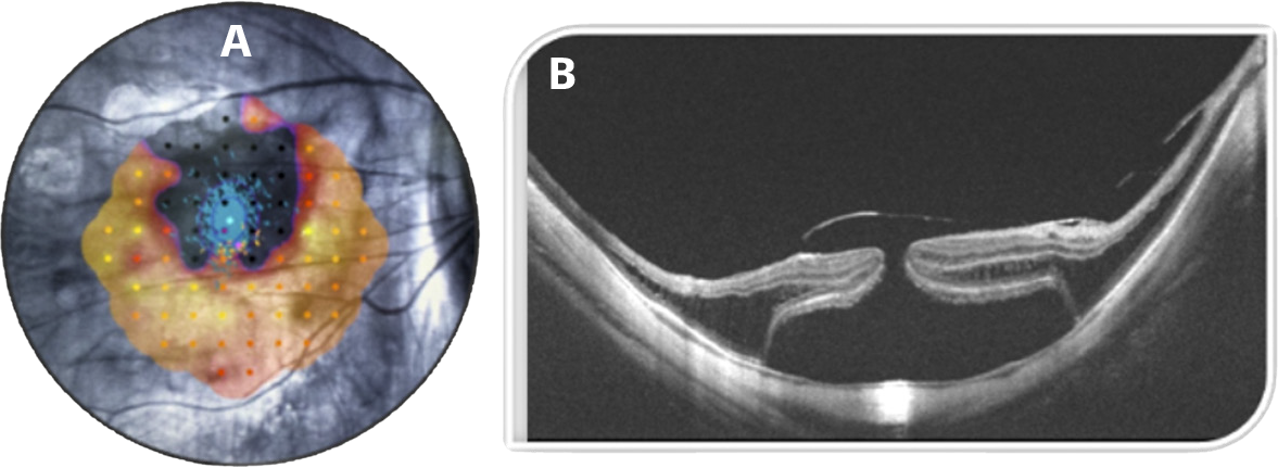 Management of myopic traction maculopathy | Community Eye Health Journal