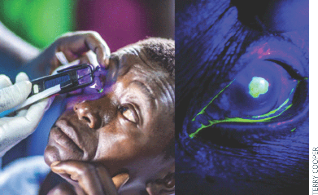 The Arclight and how to use it | Community Eye Health Journal