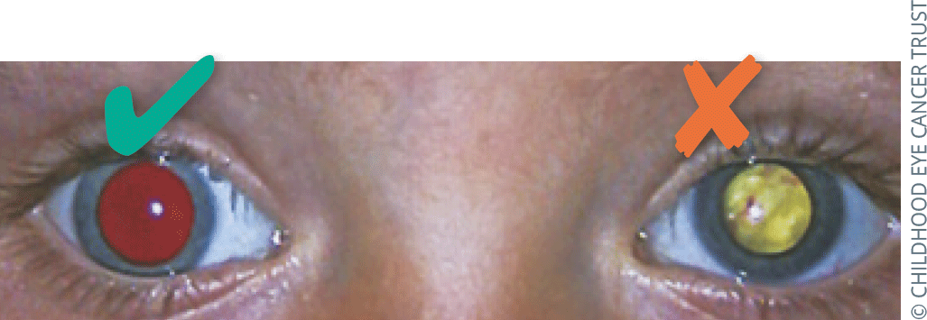 Testing the red reflex | Community Eye Health Journal