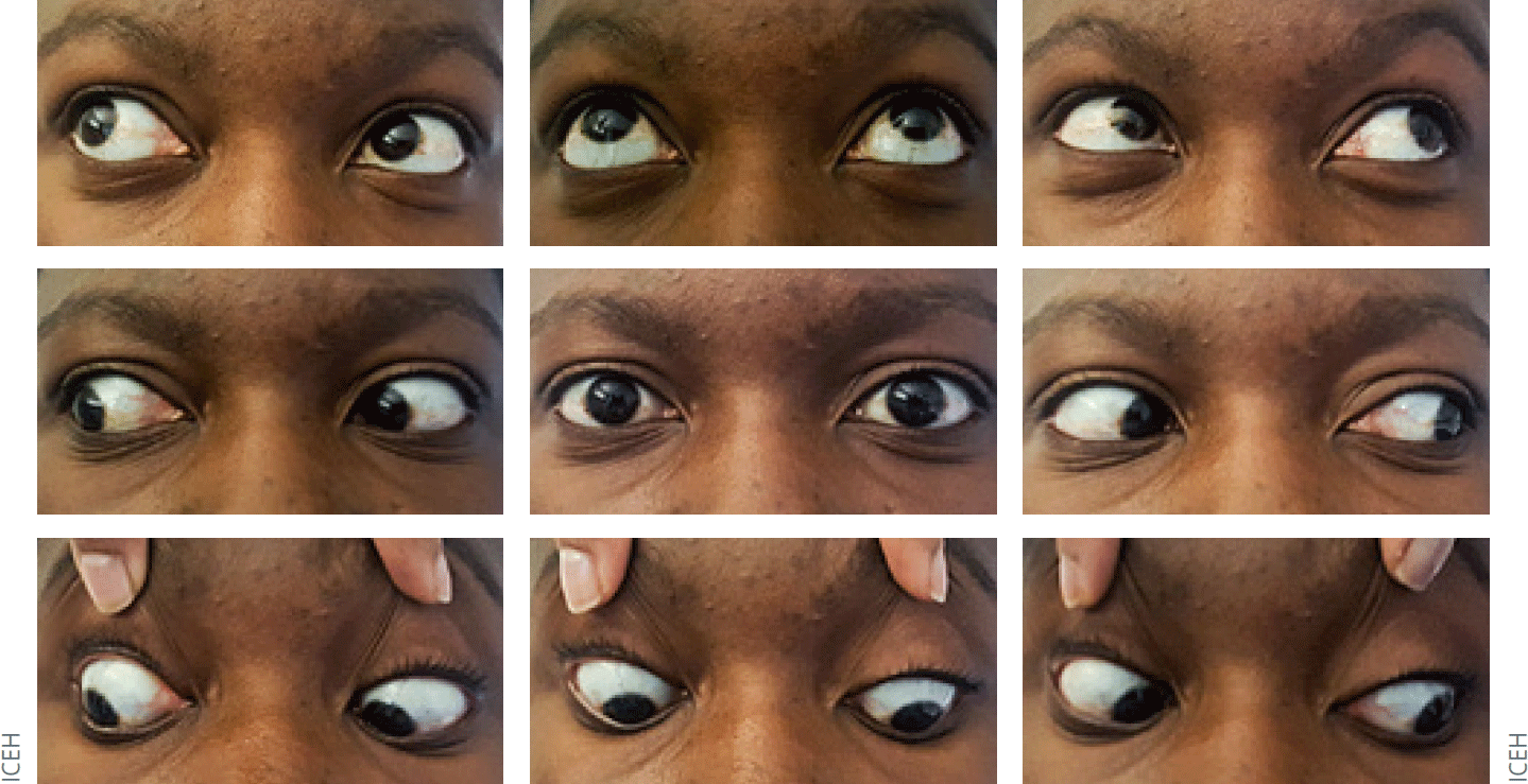 How to check eye alignment and movement | Community Eye Health Journal
