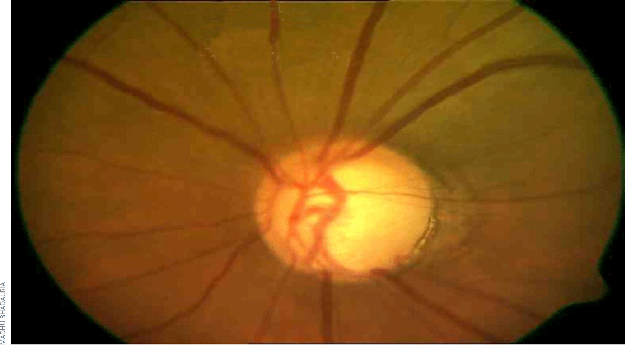 Diagnosing glaucoma | Community Eye Health Journal