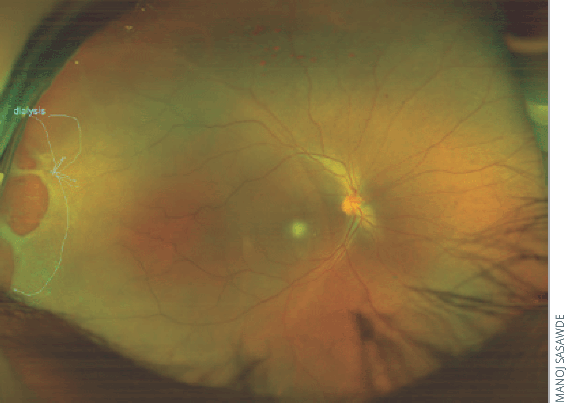Recent advances in retinal imaging and diagnostics | Community Eye ...