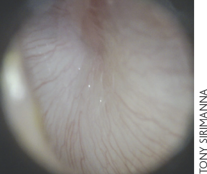 Otoscopy: some suggestions on correct technique | Community Ear and ...
