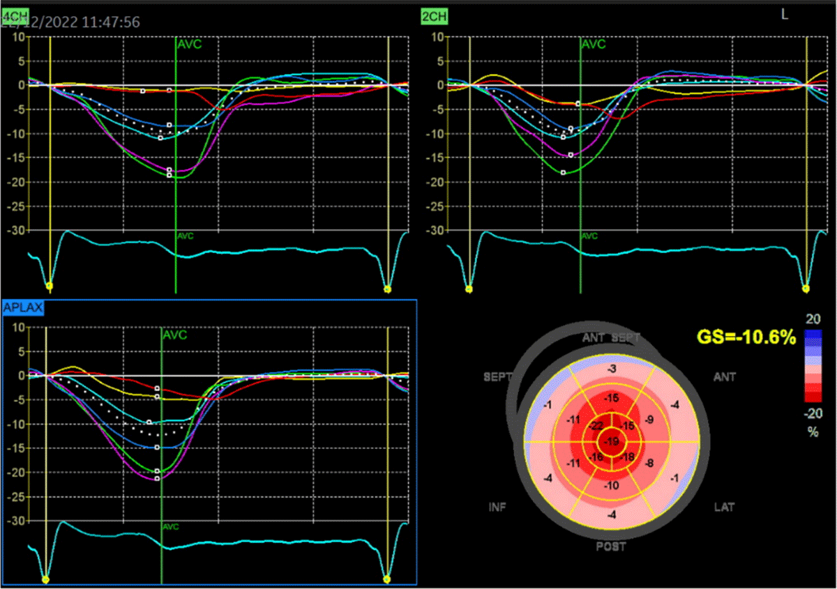 World Heart Federation Consensus on Transthyretin Amyloidosis ...