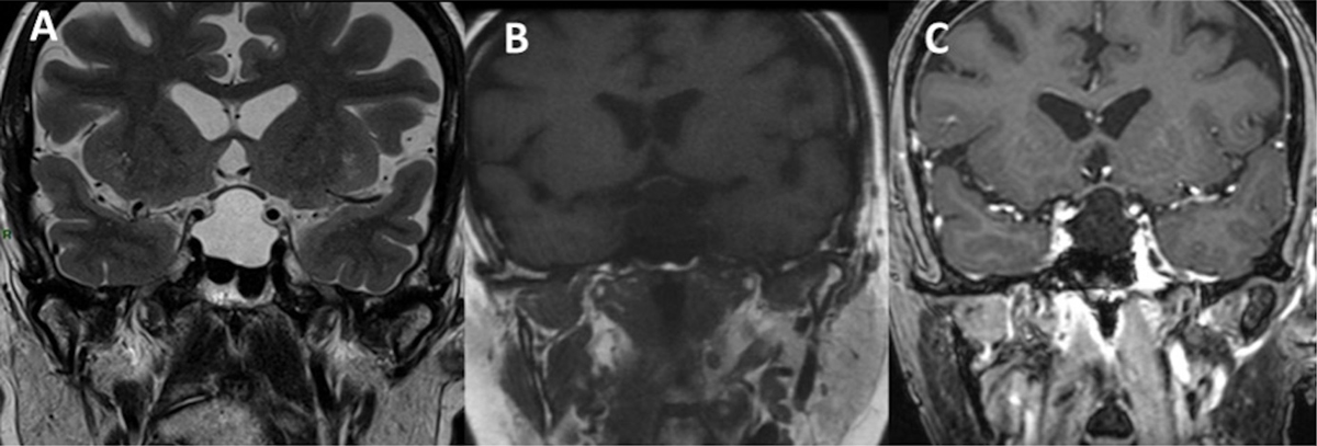 Different Faces Of Rathkes Cleft Cyst Journal Of The Belgian Society