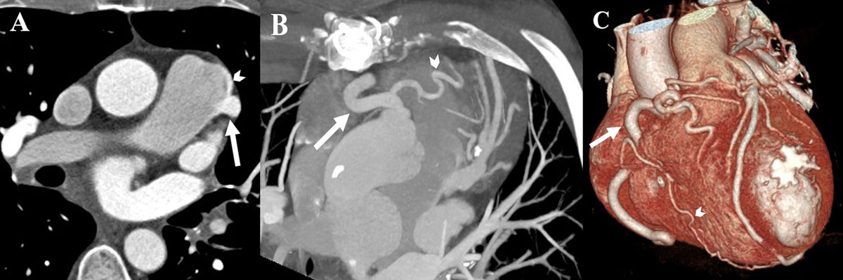 Abnormal Origin of the Left Coronary Artery: When the Bloodstream Finds ...