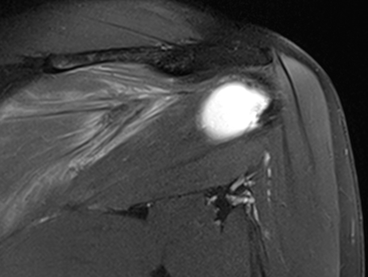 Parsonage-Turner Syndrome | Journal of the Belgian Society of Radiology