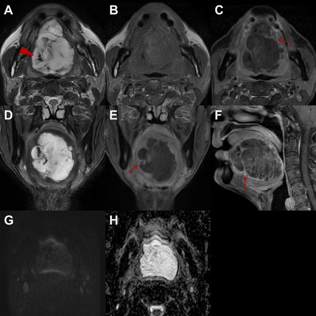 Imaging Findings Of Adenocarcinoma Arising From Lingual Foregut