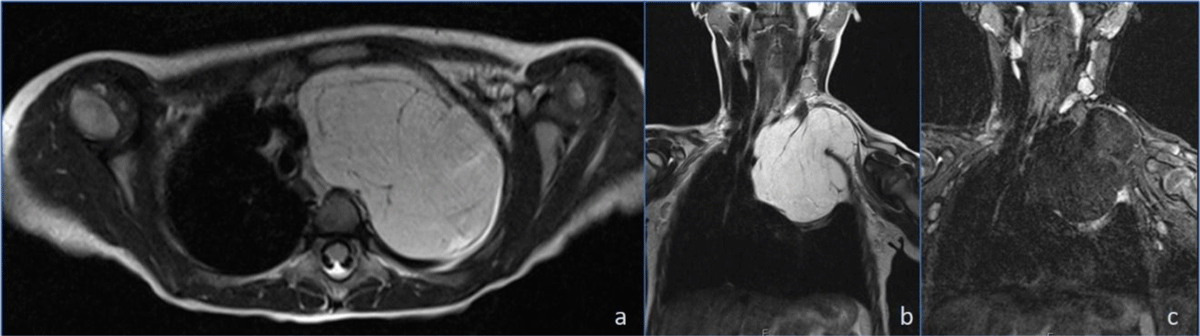 Paediatric Mediastinal Lipoblastoma | Journal of the Belgian Society of ...