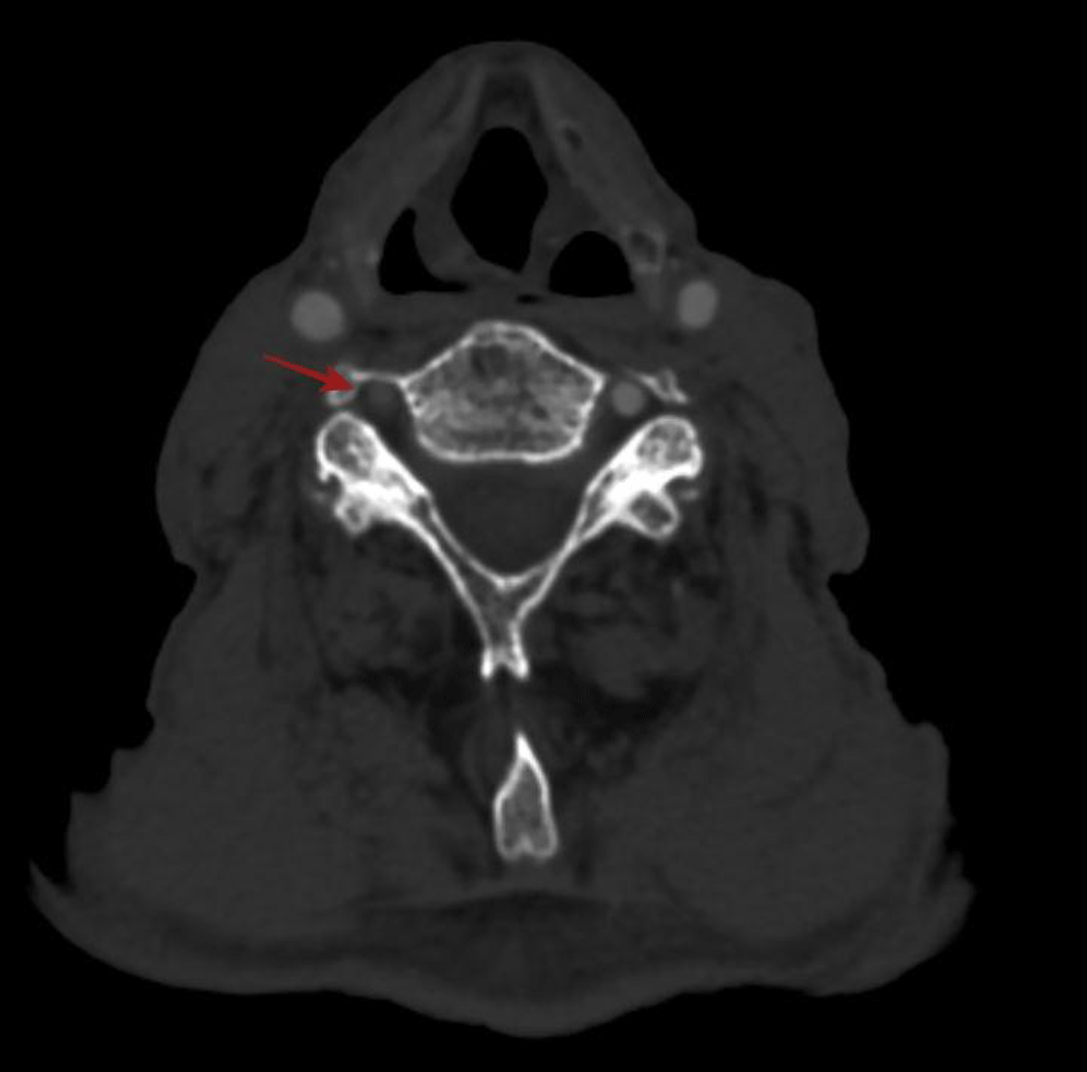 Nerve Root Compression Due to Contralateral Compensatory Hypertrophy: A ...