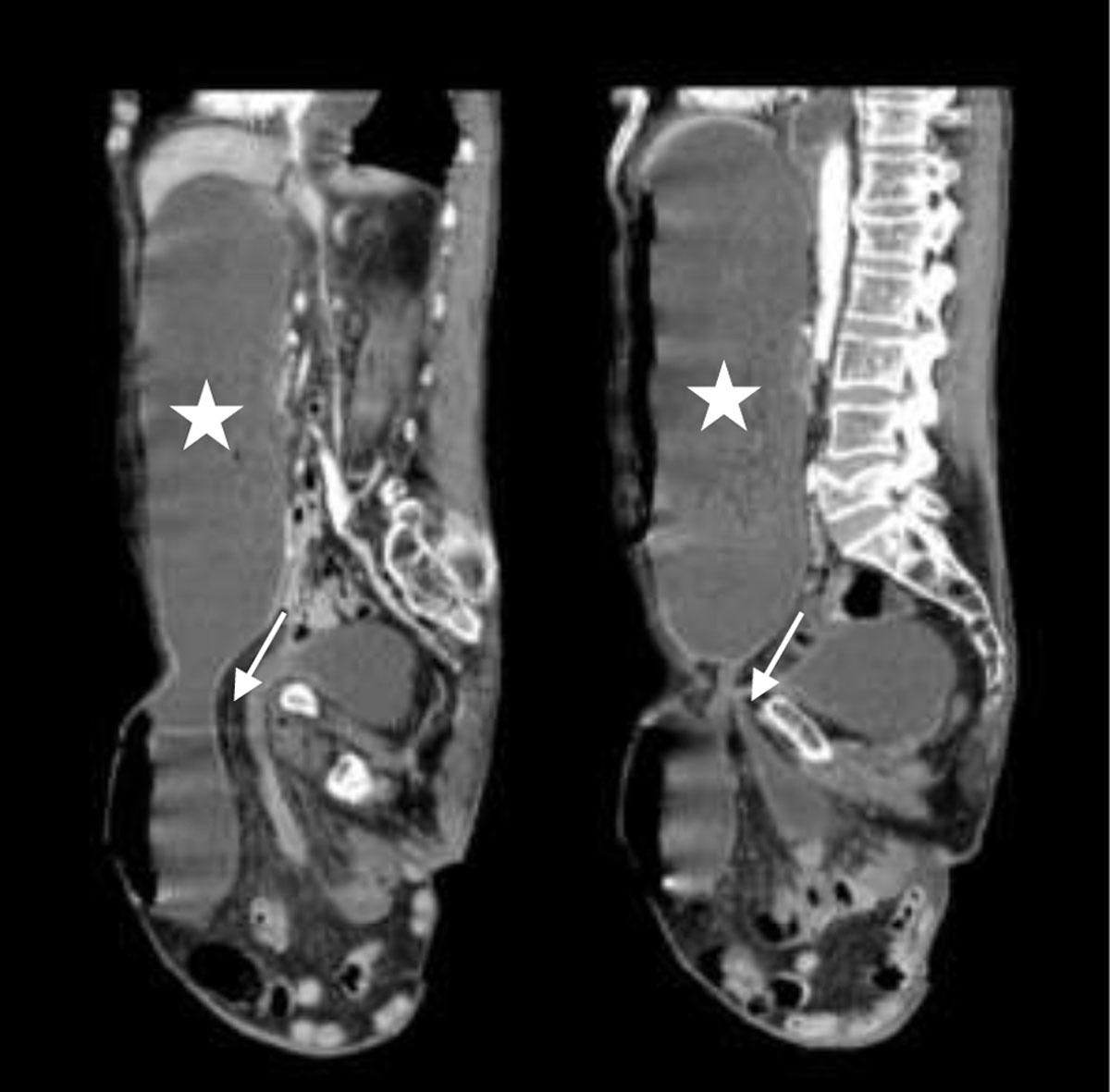 An Inguinal Stomach | Journal of the Belgian Society of Radiology