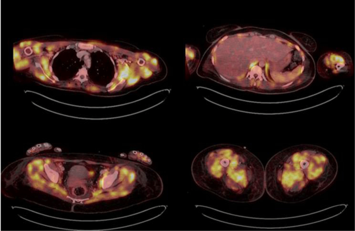 Swelling of the Muscles of the Shoulder Girdle in a CT Scan is a ...