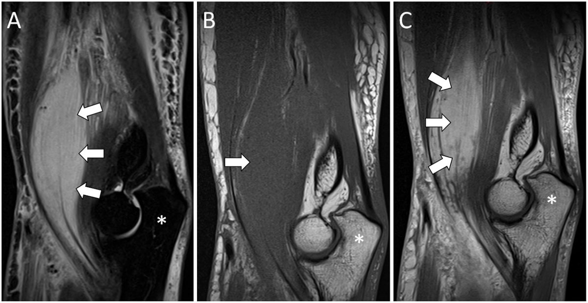 Proliferative Myositis in the Upper Extremity: Vaccination-Induced ...